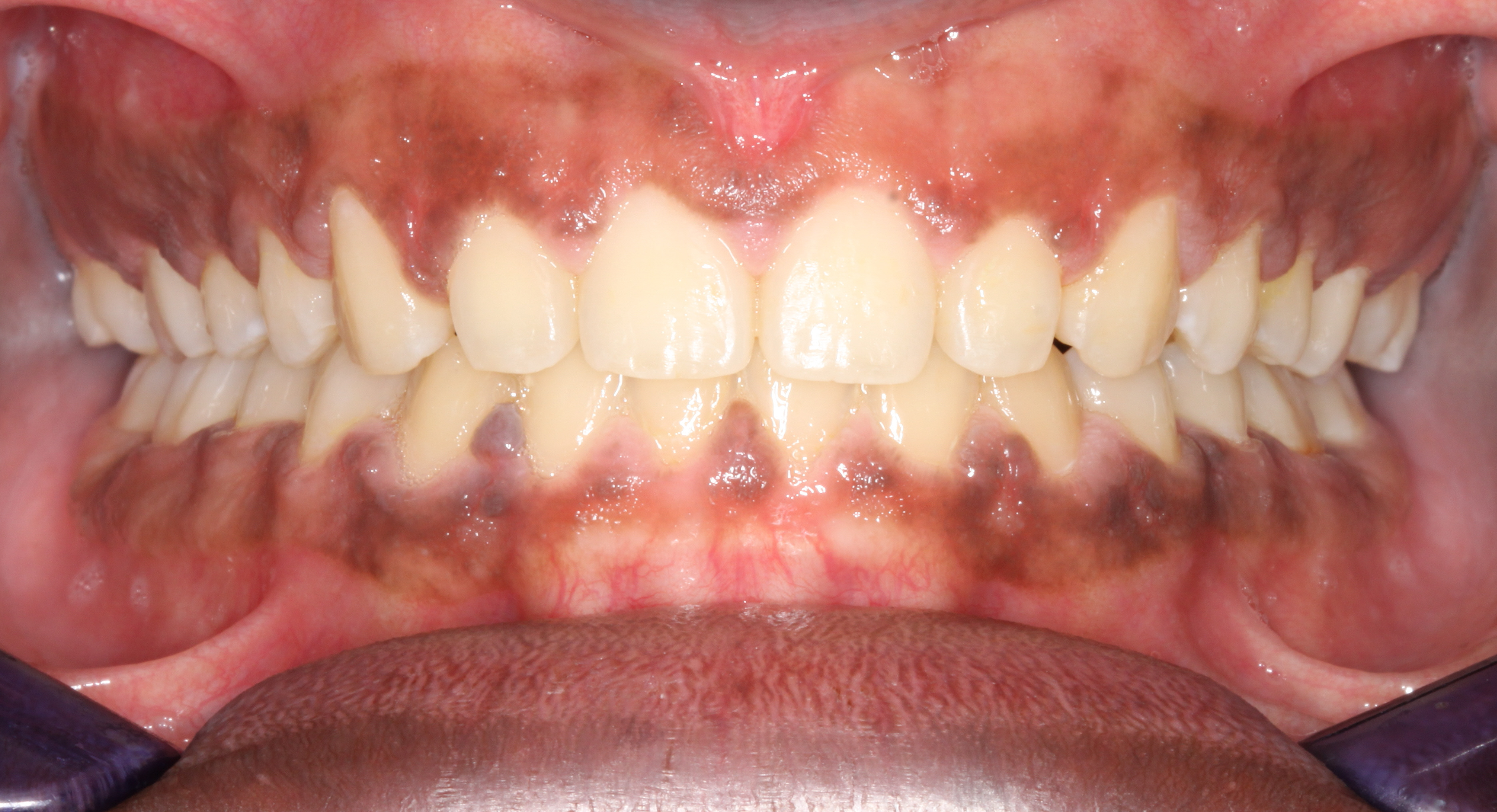 Smile Gallery - Clarity Orthodontics